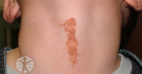 Epidermal Naevus Image
