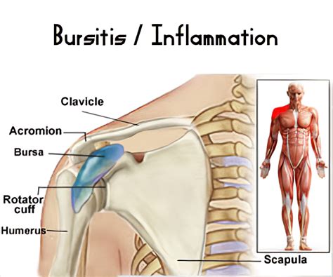 Subscapular Bursitis