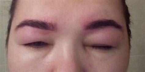 Can Ingrown Eyebrow Hair Swollen Eye