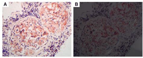 Fibrillary And Immunotactoid Glomerulonephritis Abdominal Key