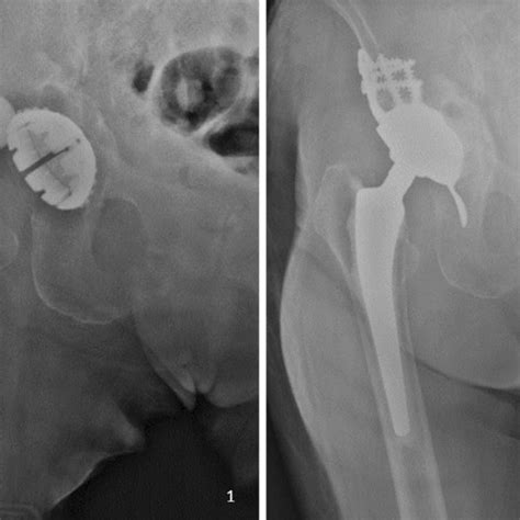 Acetabular Defect Paprosky Iii B Treated With Big And Burch Schneider