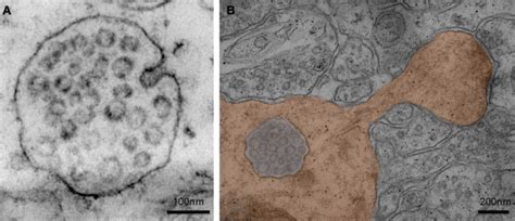 A Electron Micrograph Of A Multivesicular Body Present In A Neuron Of