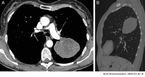 An Uncommon Intrafissural Mass Pleural Primitive Neuroectodermal Tumor Archivos De