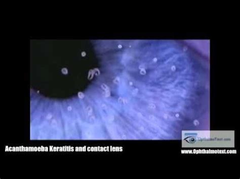 Acanthamoeba Keratitis And Contact Lens Youtube