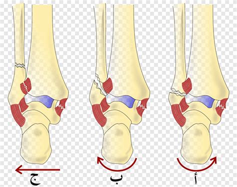 Danisweber 분류 발목 골절 Lauge Hansen 분류 뼈 골절 Malleolus Webber Books Png