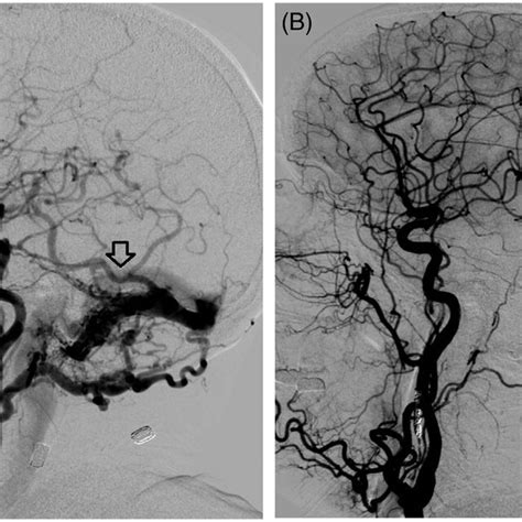 Type 3 Dural Arteriovenous Fistula Davf Lateral View Of A Common Download Scientific Diagram