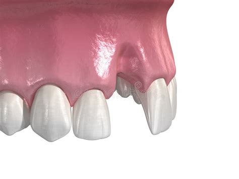 Aesthetic Defect After Losing Central Incisor Tooth Medically Accurate 3d Illustration Of Human