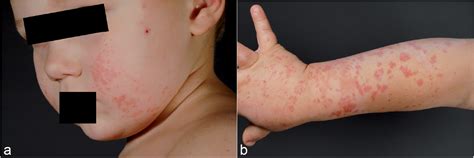 Unilateral Laterothoracic Exanthem