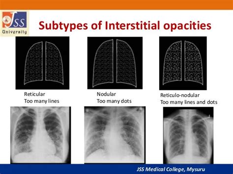 Chest X Ray Basic Interpretation