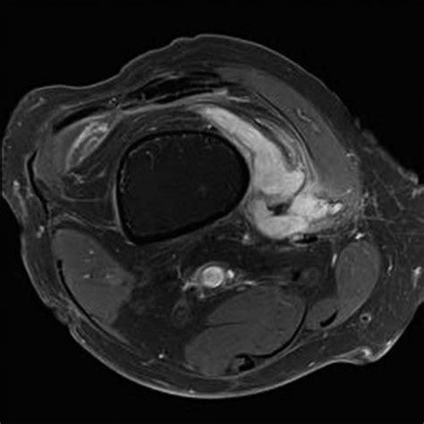 Axial T1 Weighted Mri Displaying Peripheral Nodular Enhancement Along