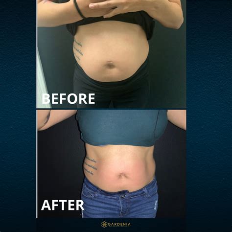 Why Ultrasonic Cavitation Is The Body Transformation Hack
