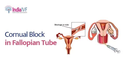 Cornual Block In Fallopian Tubes Causes Symptoms And Treatment