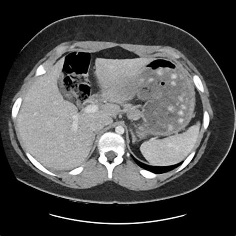 Boba Ct Companion Case Rradiology