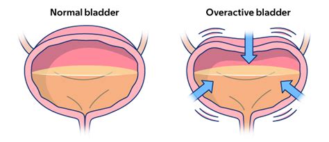 About Overactive Bladder Oab Memorial Sloan Kettering Cancer Center