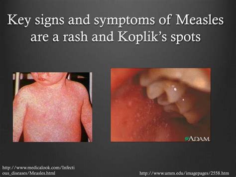 Ppt Measles Powerpoint Presentation Free Download Id 1838510
