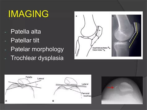 Patellofemoral Instability Pptx
