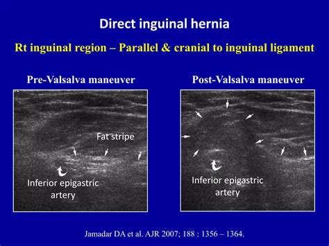 Ultrasound Of The Abdominal Wall Hernias Pptx