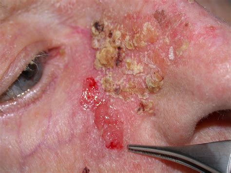 Squamous Cell Carcinoma