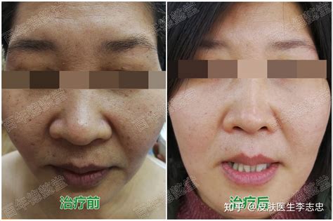 调皮有道李志忠 的想法 老年斑，专业的叫法是脂溢性角化症，长在脸上让人看上去比实际年龄大；采用激光治疗后，脸上干净了，皮 知乎