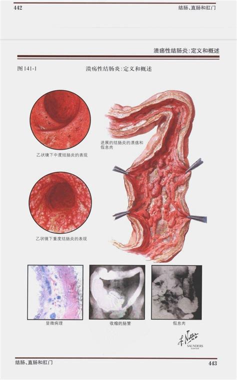 溃疡性结肠炎 知乎