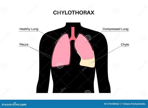 Chylothorax Anatomical Poster Vector Illustration 276458662