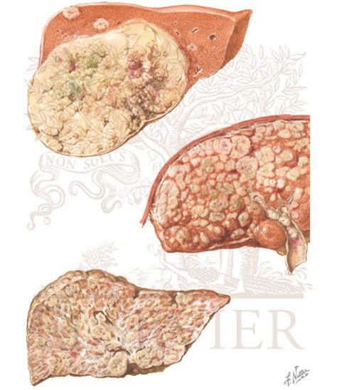 Hepatocellular Carcinoma Gross Features