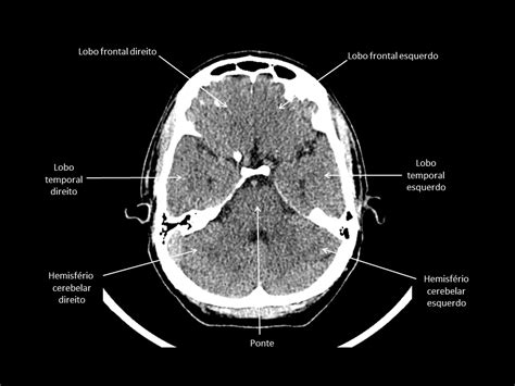 Anatomia Tc De CrÂnio