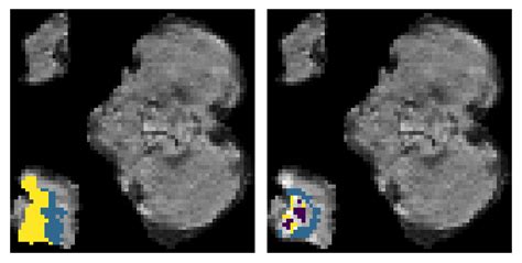 Github Avalouisefinnegan Brain Tumor Segmentation Brats Challenge With Computer Vision