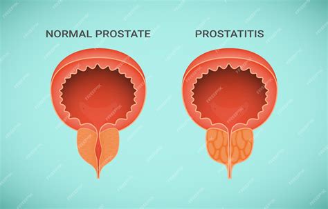 Cancer De La Prostate Arrêter La Douleur Normale Et Agrandie Maladie Oncologique Ou Urologique