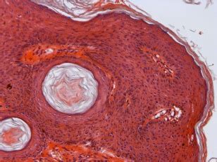 Histopathologic Picture Basal Cell Papilloma Hematoxylin And Eosin