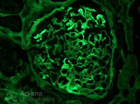 Segmental Membranous Glomerulopathy Art Of Medicine Arkana