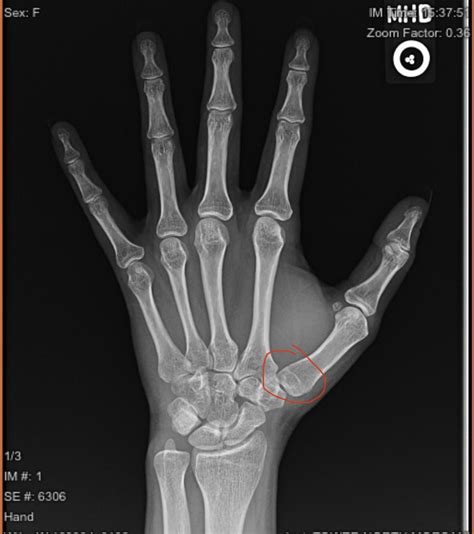 What Is That Line In The First Metacarpal R Xrays