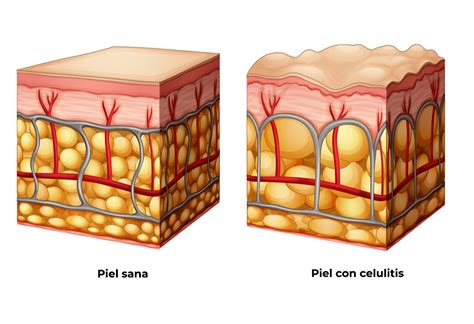 Obesidad Y Celulitis Adiposidad Local Y Generalizada Parte I