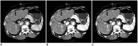 Axial Contrast Enhanced Multidetector Ct Images Obtained In 45 Year Old Download Scientific