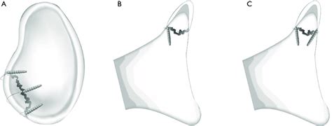 Diagram Depicting Arthroscopic Suture Anchor Techniques A Described Download Scientific