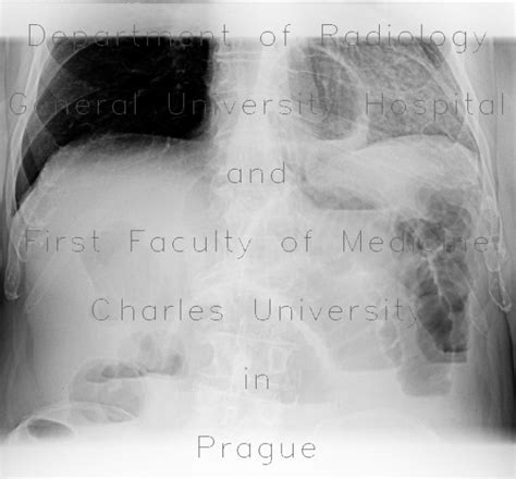 Radiology Case Small Bowel Ileus
