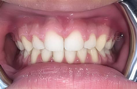 Fixed Braces Buckingham Gate Orthodontics Dentist In London