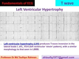 Approach To A Patient With T Wave Abnormality In ECG PPSX