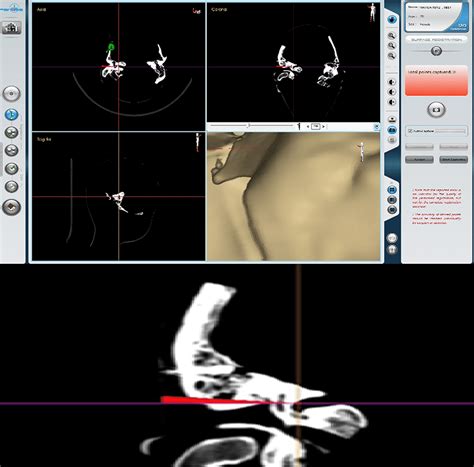 A Axial Sagittal And Coronal Views Of Rt Endoscopic Transcanal Download Scientific Diagram