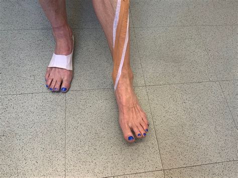Taping Ankle Posterior Tibial Tendonitis At Judy Roybal Blog