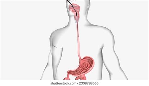 Upper Digestive Tract Endoscopy Illustrations Stomach Ulcer Endoscope