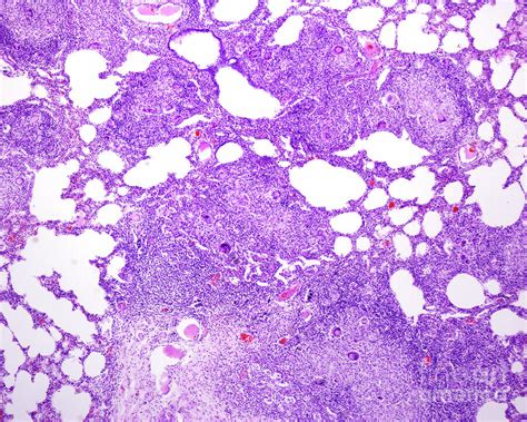 Tuberculosis 1 Photograph By Jose Calvo Science Photo Library Pixels Merch