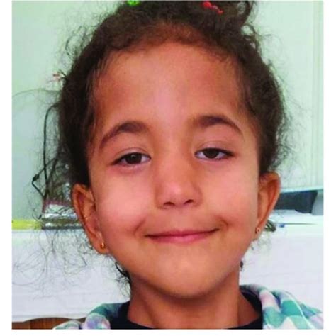 Patient At Age 8 A Dysmorphic Features High Forehead Ptosis Of
