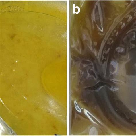 A After Resumption Of Eating The Peritoneal Fluid Cell Count Shows A