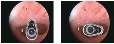 Womens Health Issues Uterine Orifice