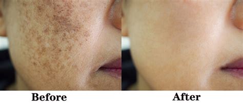 Nd Yag Laser And Picosecond Laser Difference Q Switched Nd Yag Laser