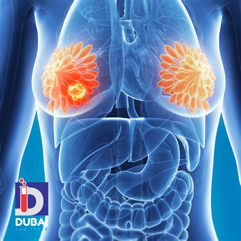 Oncotype Dx Breast Cancer Test Personalized Risk Assessment