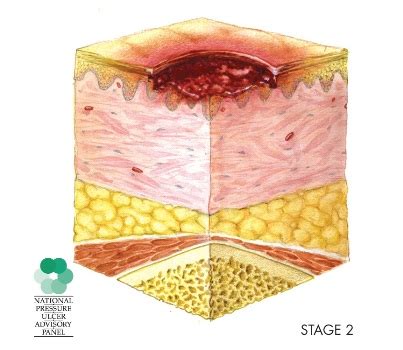 General Pressure Ulcer Information True 3digital
