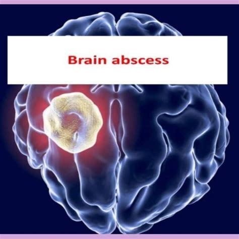 Brainabscessct Brainabscess Ct Mri Medical Radiographers Anuj Dubey ⚕️