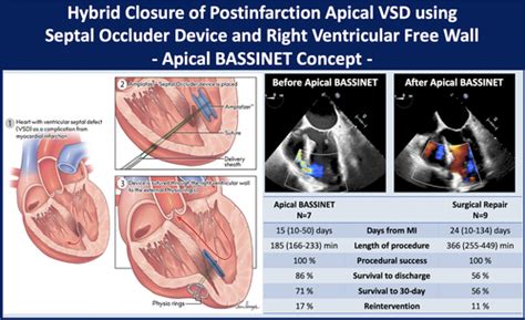 Hybrid Closure Of Postinfarction Apical Ventricular Septal Defect Using
